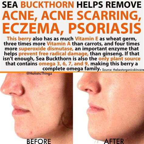 Sea Buckthorn Oil Skin Before And After Houses And Apartments For Rent