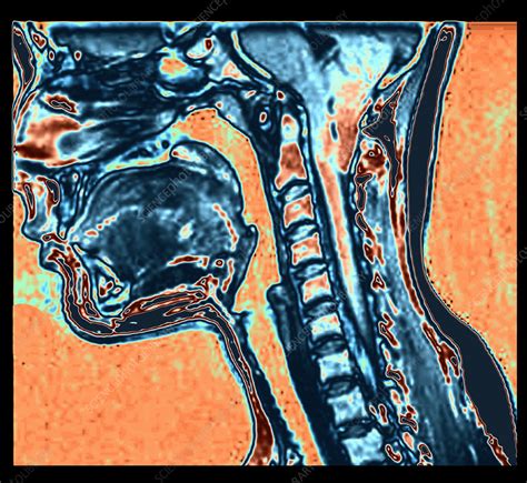 Mri Of Severe Chiari I Malformation Stock Image C0271655 Science