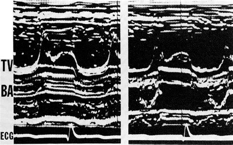 Figure 1 From Echocardiography Of The Intra Atrial Baffle In Dextro
