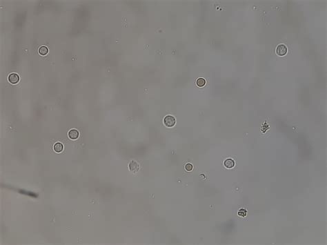Pleural Fluid Microscopy Introduction Principle Test Requirement