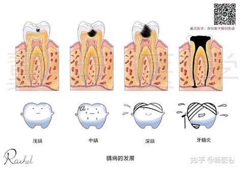 谷谷给你解析龋病（蛀牙）的原因和防治 知乎