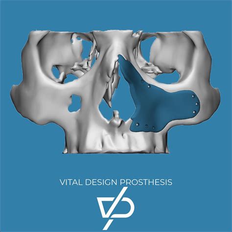 Reconstrucción Maxilar Superior Vital Design Prosthesis