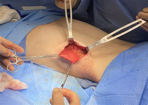 Ld Muscle Excision Dr Barry Eppley Explore Plastic Surgery