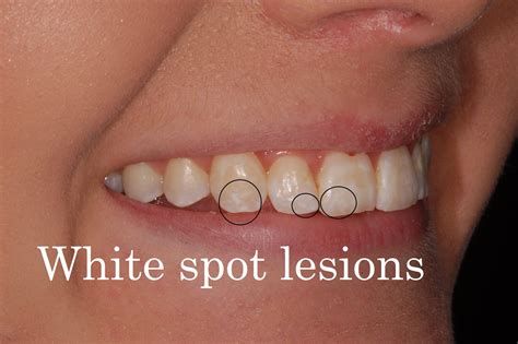 Why Do I Have Brown Spots On My Teeth With Braces