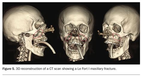 Maxillary Fracture