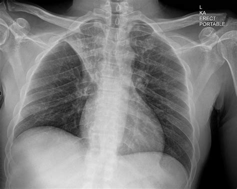 186lu Right Upper Lobe Collapse Lungs