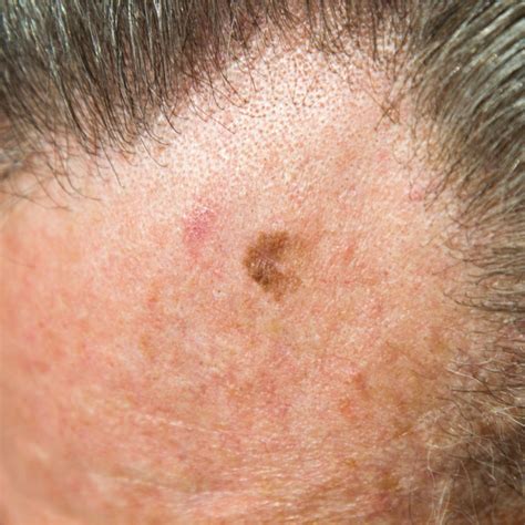 Lentigo Maligna Frequenz