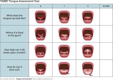 Kort Tungband Hos Barn Folkhälsa Och Sjukvård