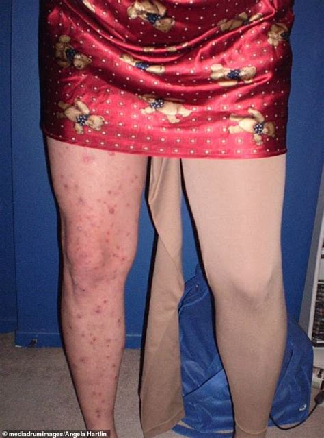 Excoriation Disorder