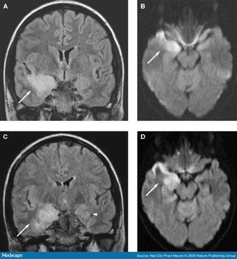 With Acute Herpes Simplex