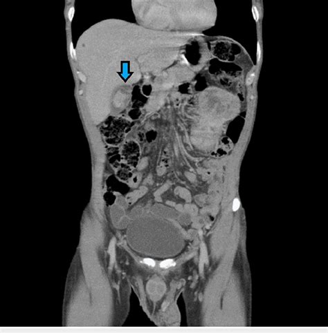 Ct Abdomenpelvis With Contrast Demonstrating A Soft Tissue Mass Within