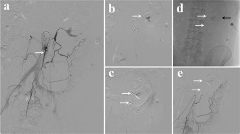 Ima Digital Subtraction Angiography And Embolization Of Imaa Involving