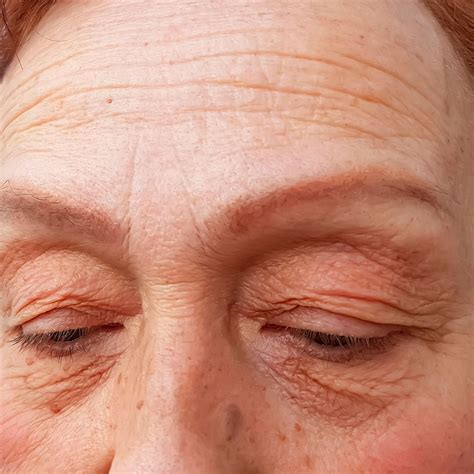 Fine Lines And Wrinkles Removal Abu Dhabi Anti Aging Treatment