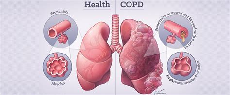 Chronic Obstructive Pulmonary Disease Copd Aneurin Bevan University Health Board