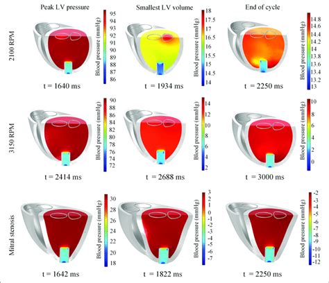 Snapshots Of The Biventricular Model With Lvad Depicting The Lv Blood