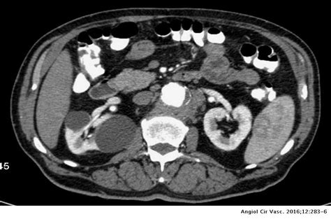 Tuberculous Aortitis A Case Report Angiologia E Cirurgia Vascular