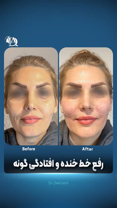 ‎دکتر آنا دیلمیپزشک زیبایی‎ ‎سه تا تزریق ژل که معجزه میکنه چون بدون اینکه چهره تون رو تغییر