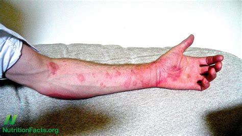 Allergic Reaction To Tick Bites