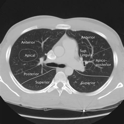 Chest Anatomy Radiographs And Ct By Alexander Baxter