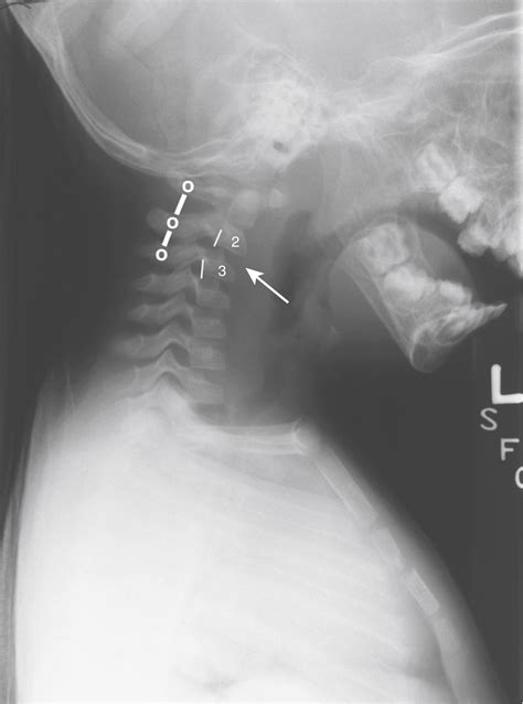 Spinal Injuries Clinical Tree