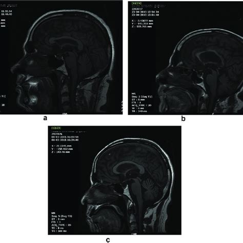 Thickness Of Pars Compacta Of Substantia Nigra Measured As A