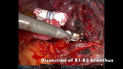Left S1 S3 Robotic Segmentectomy And Mediastinal Lymphadenectomy Youtube