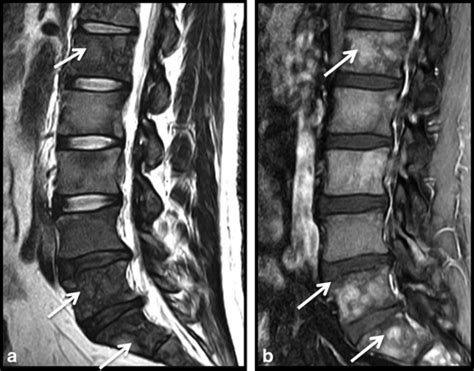 Sclerotic Lesions Of The Spine Mri Assessment Mugera 2013
