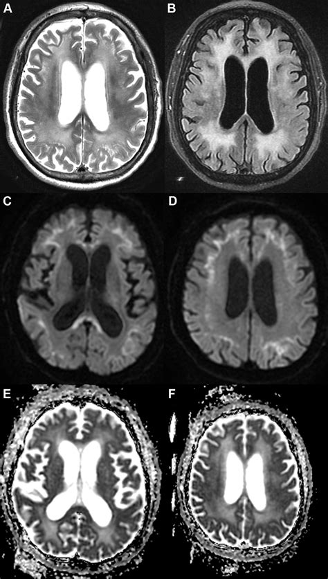 Neuronal Intranuclear Inclusion Disease Radiology