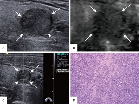 Figure 1 From Acoustic Radiation Force Impulse Induced Strain