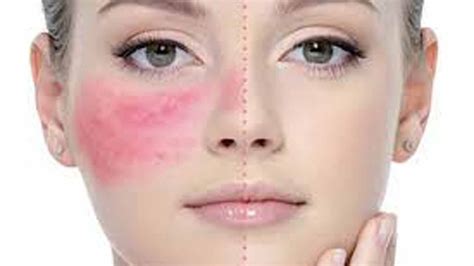 Piel Gruesa Roja Y Con Granos Qué Es La Rosácea Y Cómo Combatirla Infobae