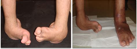 Clubfoot Reconstruction Naples Miami Florida And New York City