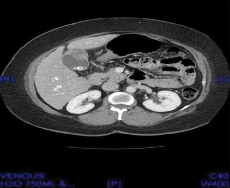 Triple Phase Ct Chest Abdomen And Pelvis Download Scientific Diagram