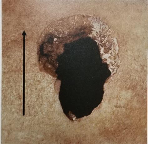Introduction To Gunshot Wounds Practical Forensic Pathology