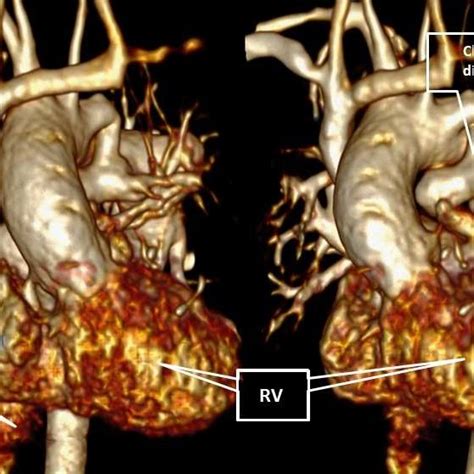 Pdf Leadless Pacemaker Implantation In A Patient With Complex