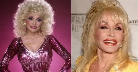 Dolly Parton Plastic Surgery Before And After Breast Implants Botox