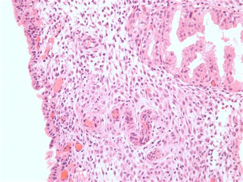 Cases Uterine Pathology