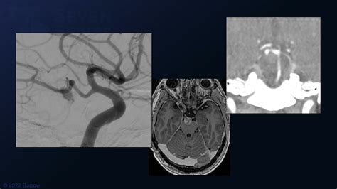 154 Clipping Of A Superior Hypophyseal Artery Aneurysm With Extra