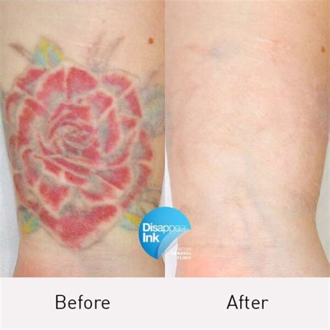 Tattoo Removal Before And After What You Need To Know Must Read This