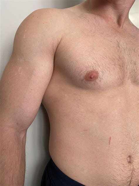 Tinea Versicolor Chest