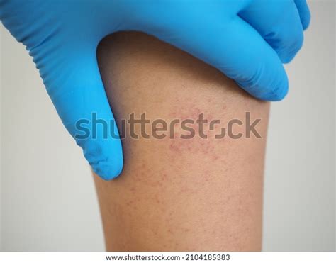 Photos Blood Spots Under Skin Photos Images And Pictures Shutterstock
