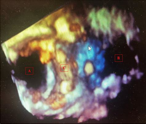 3d Transeophageal Echocardiogram Image Demonstrating Both Sapien 3 And