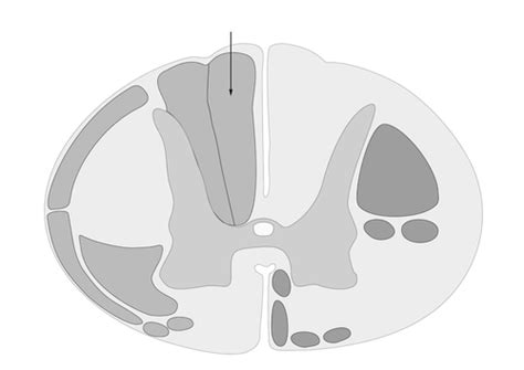 Stroke Brainstem Lesions And Tract Lesions Flashcards Quizlet