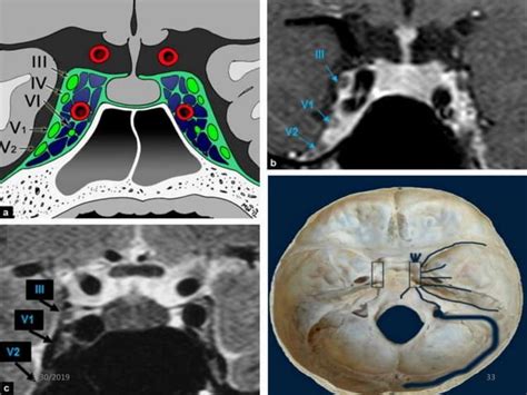 Pituitary Adenoma Radiotherapy Planning Pptx Endocrine And