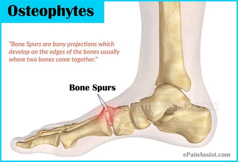 Bone Spurs Or Osteophytes Treatment Causes Symptoms