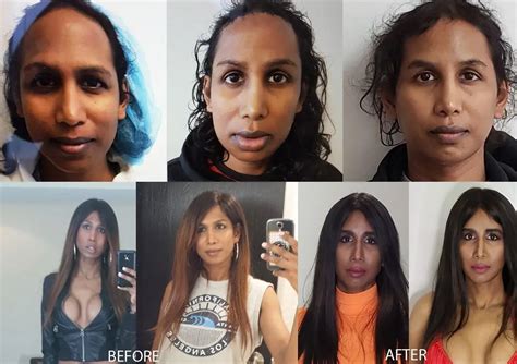 1 Yr Post Op Ffs V Line Jaw Type 3 Forehead Brow Lift Hair Line