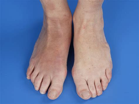 Acrodermatitis Atrophicans