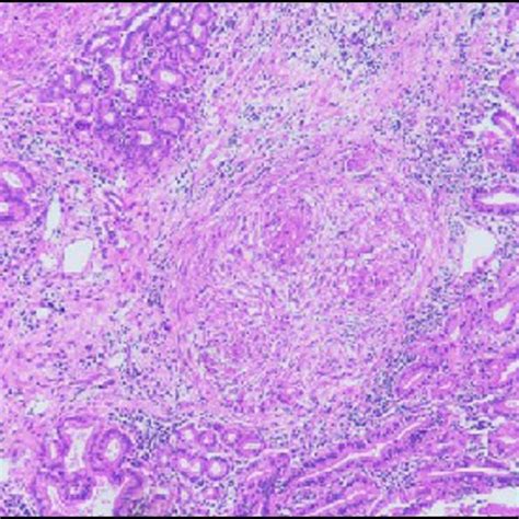 Microphotograph Of The Gallbladder Showing Gallbladder Mucosa And