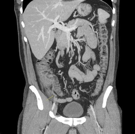Caecal Diverticulitis With Micro Perforation Eurorad