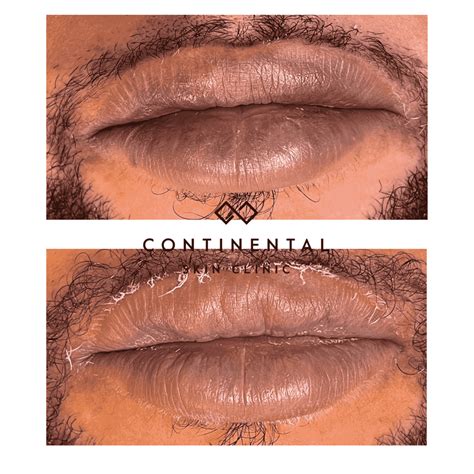 Lip Color Pigmentation At Brianna Rocher Blog