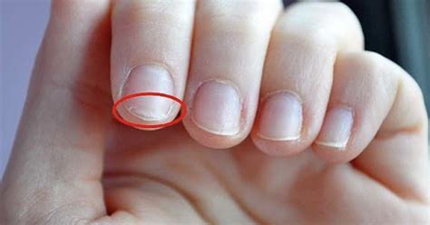 What Do Fingernails Look Like With Thyroid Disease At Paul Nichols Blog